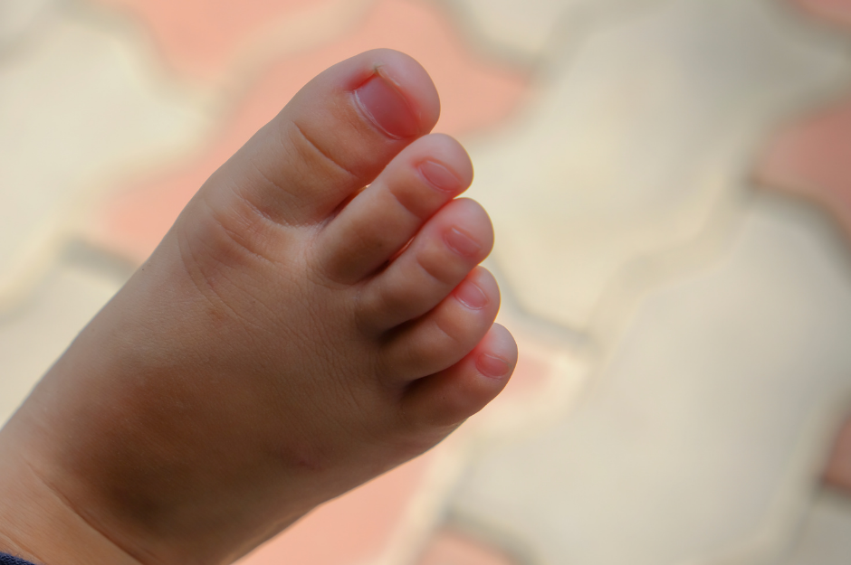 Ingrown Toenail - Help! My Child’s Ingrown Toenail Keep Coming Back