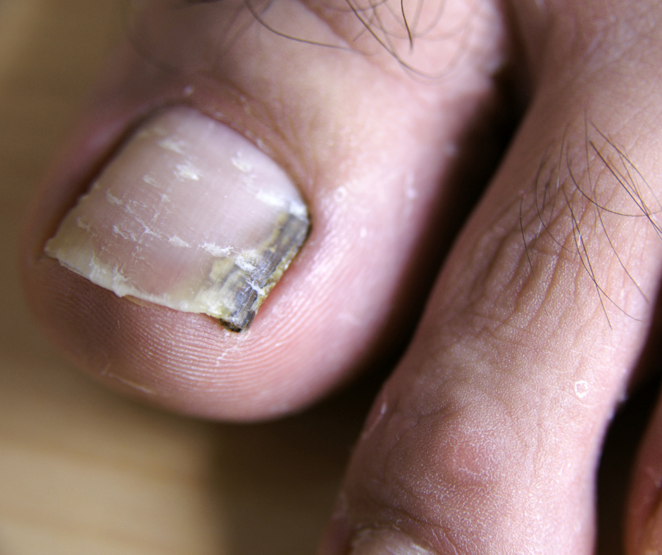 Ingrown Toenail - Signs Of A Melanoma Beneath Your Toenail