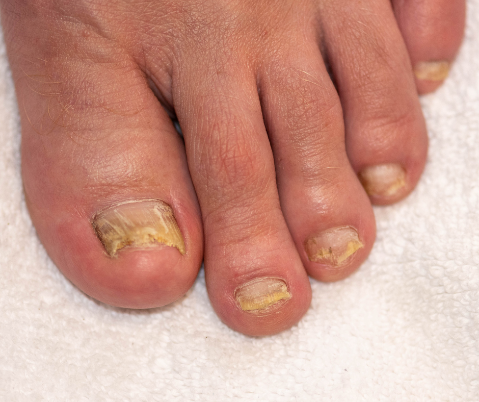 Ingrown Toenail - Why Do Toenails Thicken?