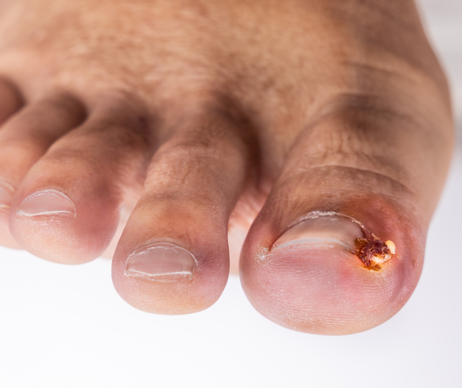 Ingrown Toenail - Your Ingrown Nail FAQs, Answered